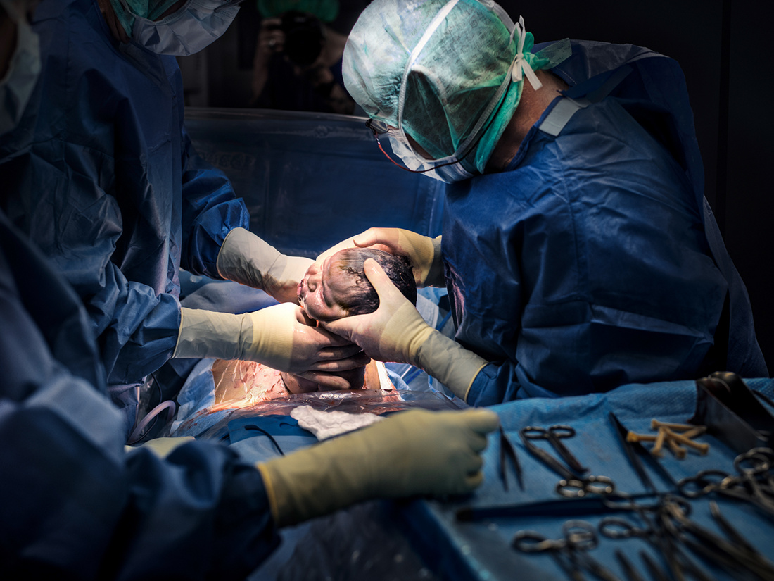 Cesarean Section Procedure