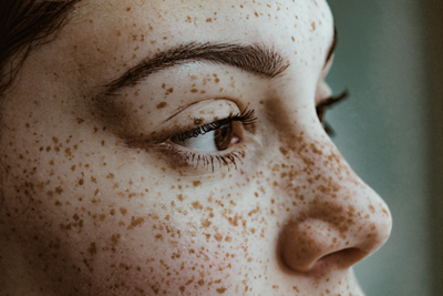 Shifting trends in treating hyperpigmentation